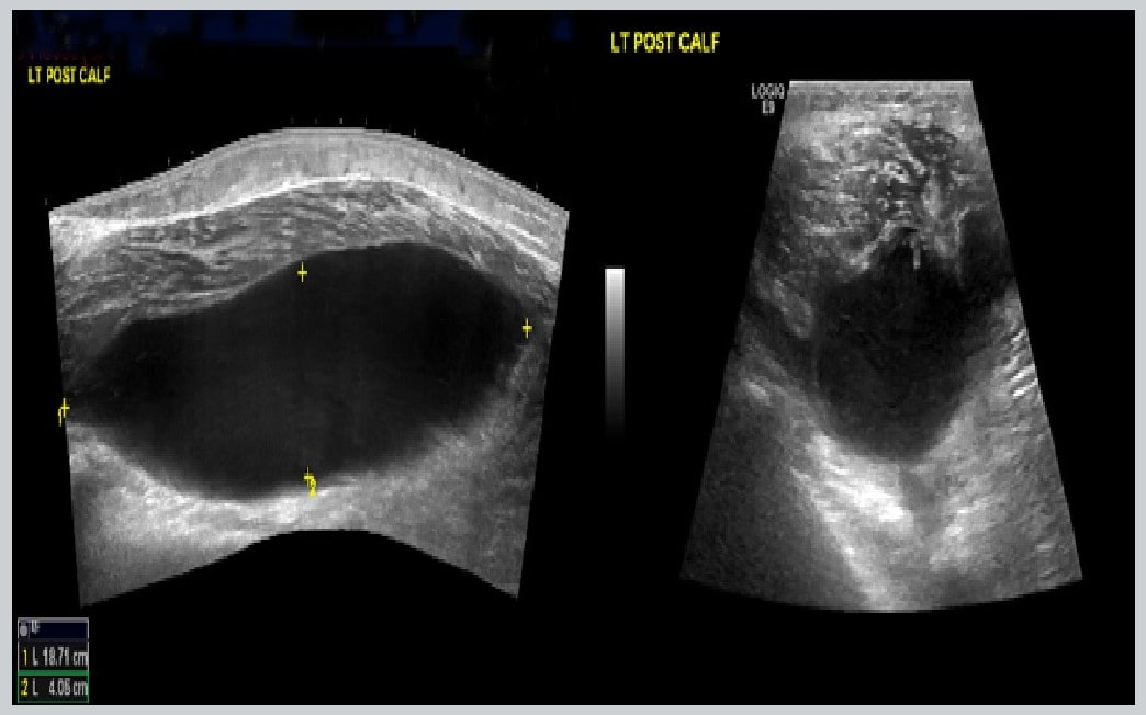Ekte Eggstokk Med Cyste