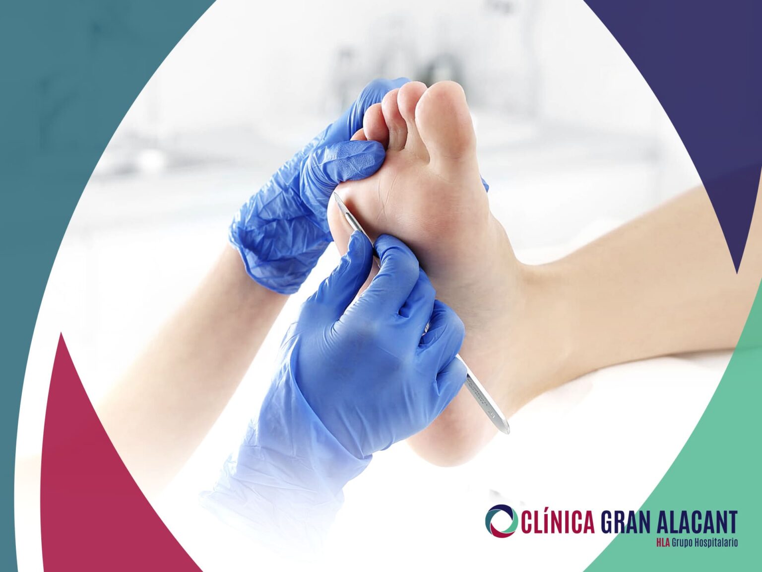 Ojo de gallo: características, causas, síntomas y tratamiento - Clinica ...