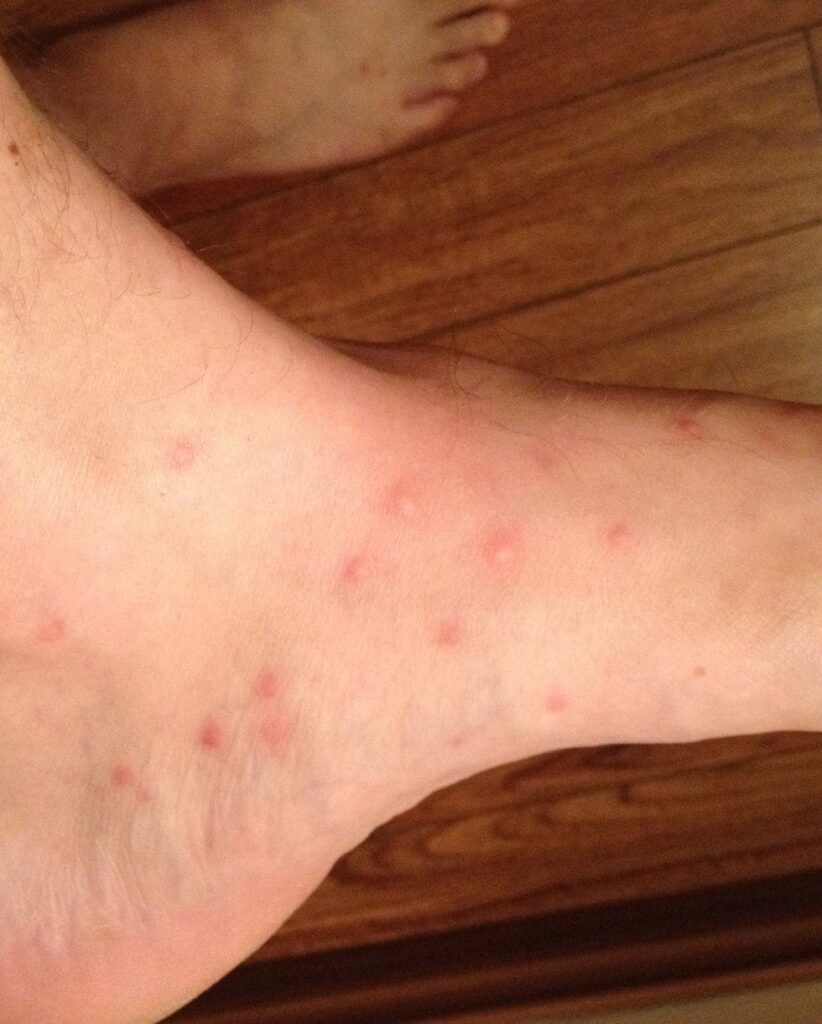 Tipos de picaduras de insectos - Clinica Gran Alacant