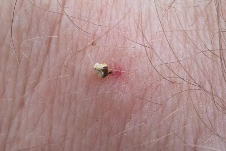 Types of insect bites - Clinica Gran Alacant