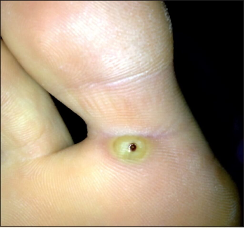 Types of insect bites - Clinica Gran Alacant