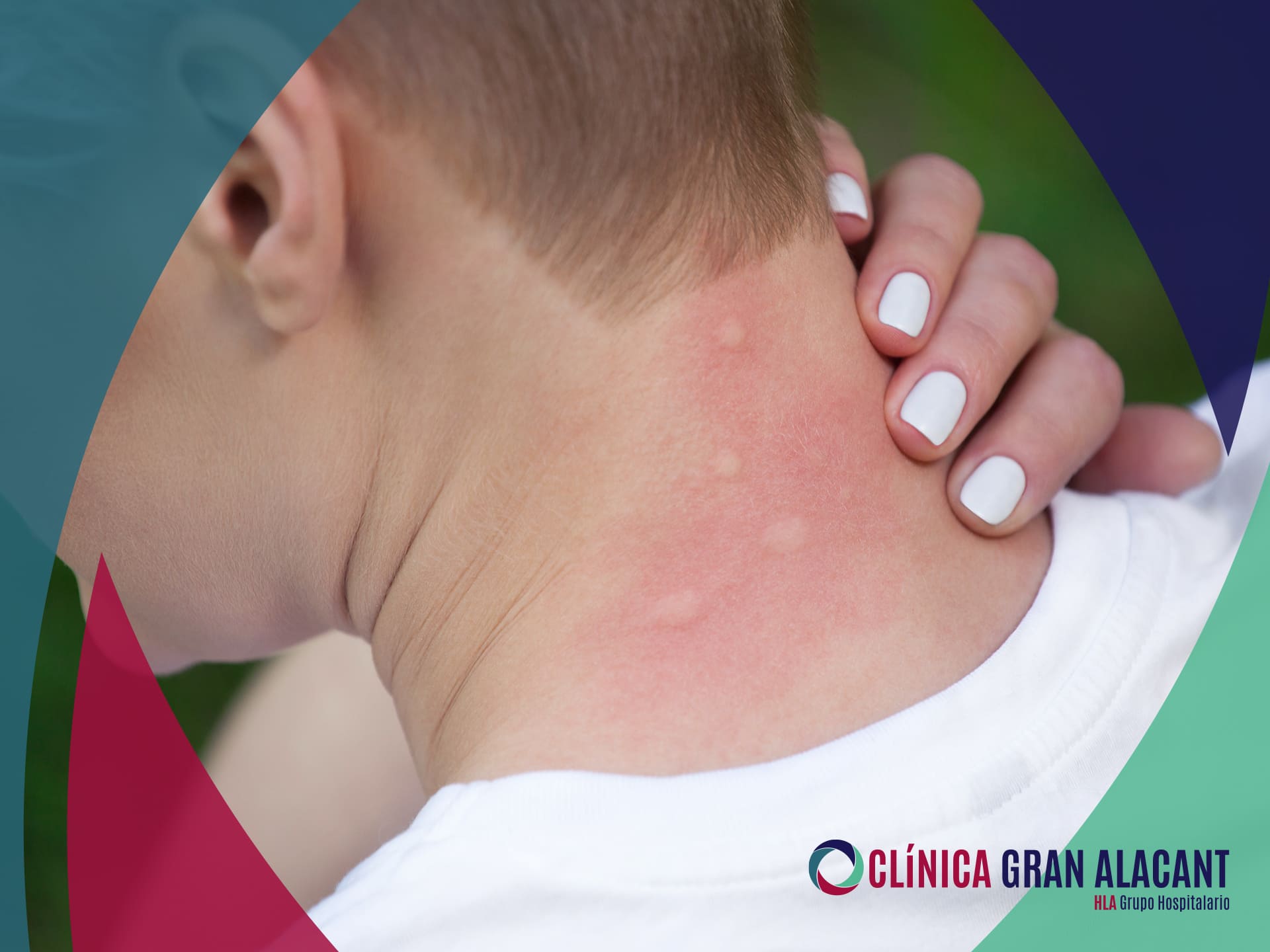 Types of insect bites - Clinica Gran Alacant